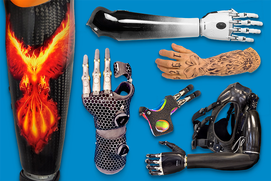 What is a Hybrid Upper Limb Prosthesis?